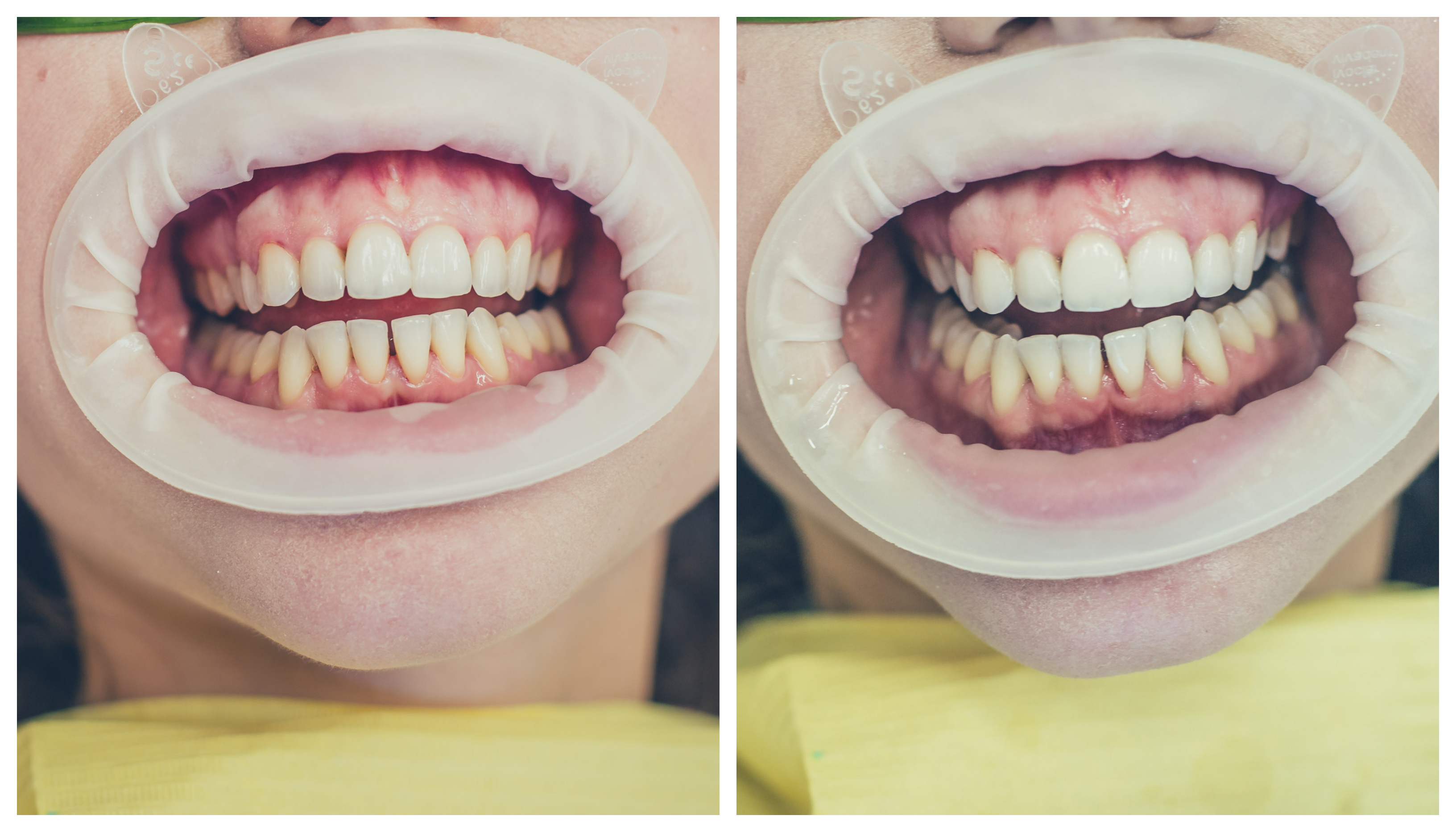 Albire dentara cu laser la Life Dental Spa - AnotherSide Of Me